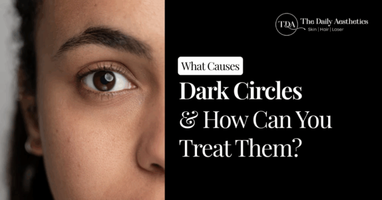 What Causes Dark Circles & How Can You Treat Them?